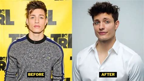 Matt Rife Plastic Surgery And Weight Loss Glow Up And Before After Pictures