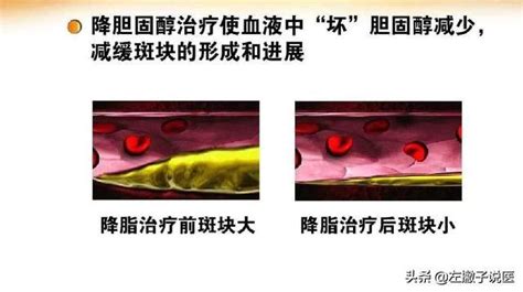 動脈粥樣硬化斑塊可以逆轉和完全消退嗎？一文為你揭開真相 每日頭條