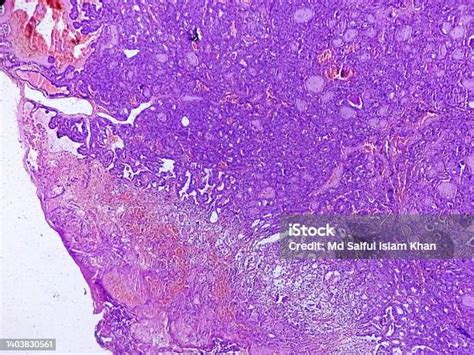 전이성 유두 갑상선 암종 중앙 림프절 암에 대한 스톡 사진 및 기타 이미지 암 암종 유두근 Istock
