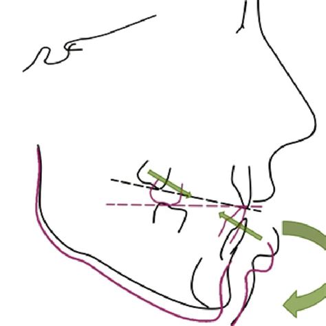 The Class Iii Elastics Elongate Upper Molar And Lower Incisors That