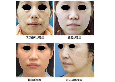 顔が大きく見える原因と小顔になる方法顔を小さくする整形 輪郭形成小顔整形 コラム池袋の美容整形美容外科小顔整形顔痩せ輪郭