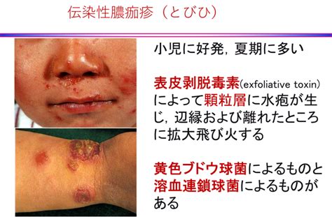 とびひ（伝染性膿痂疹）（三宮・皮膚科） はやし皮ふ科クリニック