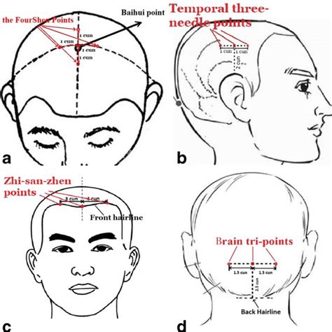 The Treatment Process Of Acupoint Injection Therapy And Subcutaneous