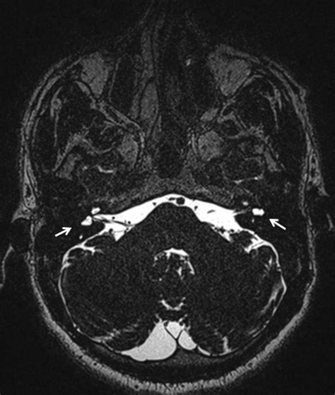Aplasia Of Lateral Semicircular Canals Medizzy Journal