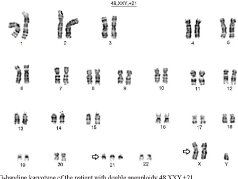 Klinefelters Syndrome Karyotype
