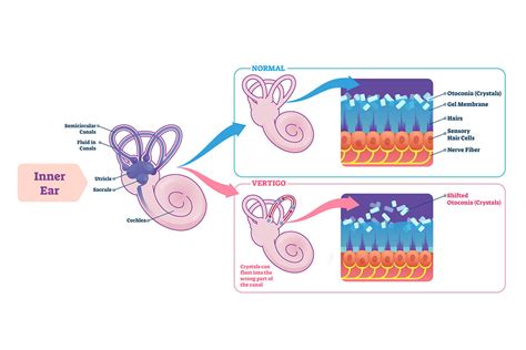 Inner Ear Diagram Vertigo