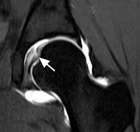 Hip Labrum Tear Mri