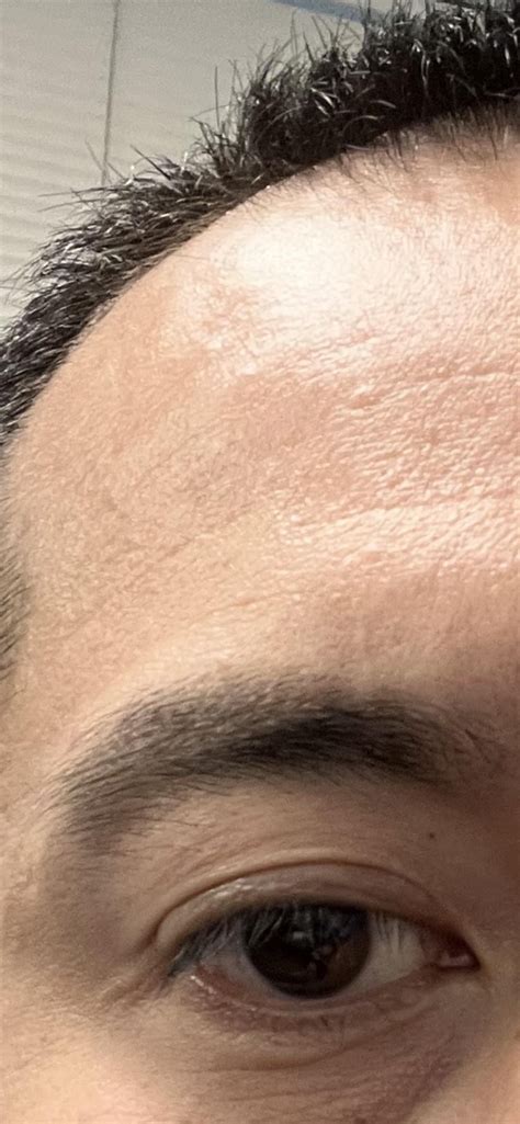 I Wanted To Share My 1 Year Results From Tretinoin Acne Scars And