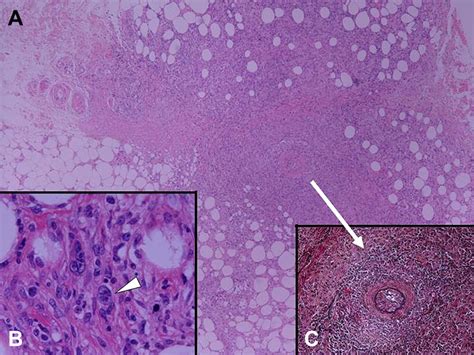 Methotrexate Related Lymphoproliferative Disorder With Extensive