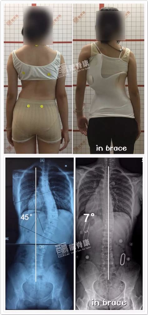 最新病例：青少年脊柱侧弯患者脱支具的条件有哪些？
