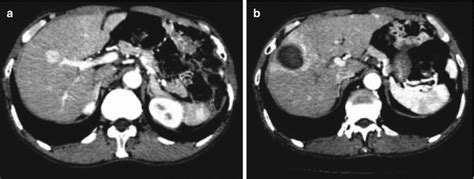Radiological Assessment And Follow Up After Radiofrequency Ablation