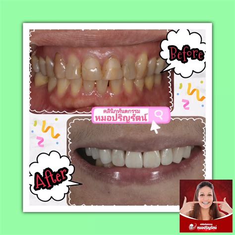 ~⭐~ รีวิวเคสวีเนียร์ คุณหมอดนตร์ ‼️ คลินิกหมอปริญรัตน์ 304 กบินทร์