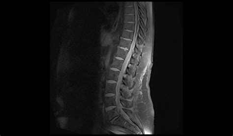 Spinal Epidural Hematoma Mri Radiology Article On Spinal Epidural Hematoma