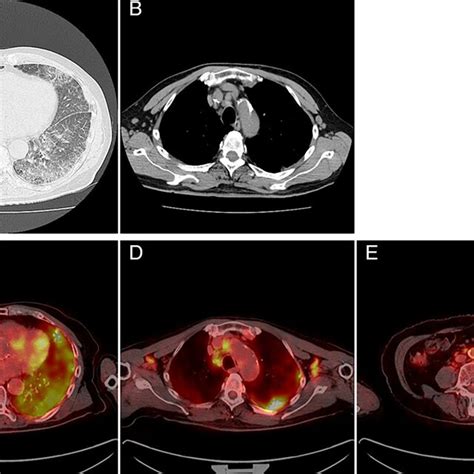 Chest Computed Tomography Ct At The First Consultation To Our Download Scientific Diagram