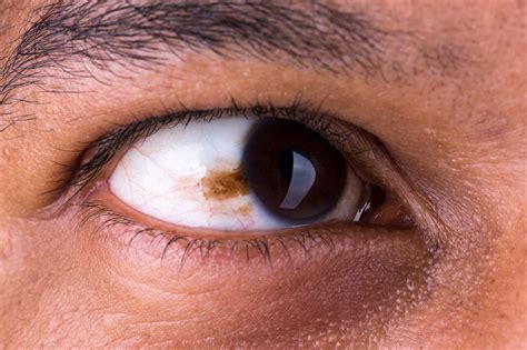 Ocular Melanoma Treatment