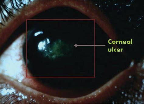 Figure 1 From A Case Of Phaeohyphomycosis Causing Keratitis Due To