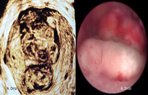 Diagnostic Hysteroscopy For Submucous Myomas Isge