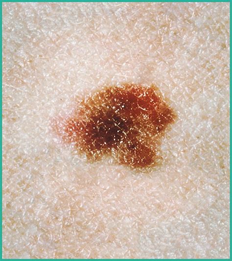Atypical Moles Skin Check In Meridian Id
