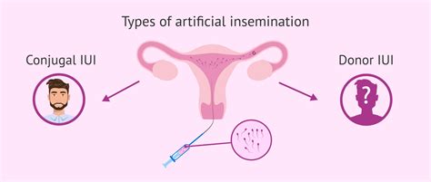 What Are The Advantages Disadvantages Of Artifical Insemination