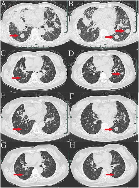 Frontiers Newly Emerged Ros1 Rearrangement In A Patient With Lung Adenocarcinoma Following