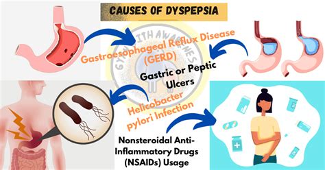Dyspepsia Icd 10 Code Causes Symptoms And Best Treatment