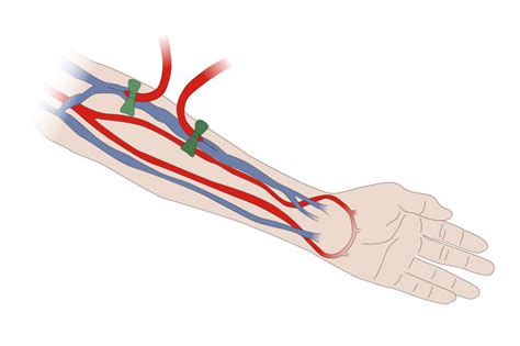 Unmet Need Avf Aplagon