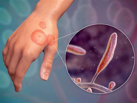 2 Drug Resistant Ringworm Cases Detected In Nyc Cdc New York City