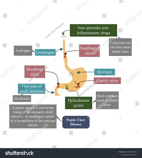 Peptic Ulcer Common Causes 库存插图 2265767567 Shutterstock