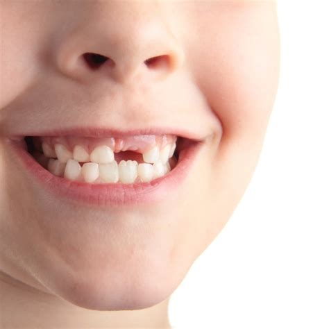 12 Como Fica A Gengiva Do Bebê Quando Está Nascendo Dente Free Foto
