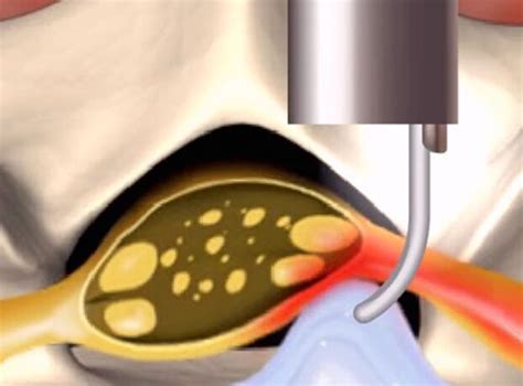 Endoscopic Discectomy Recovery In Delhi Ibs Hospital