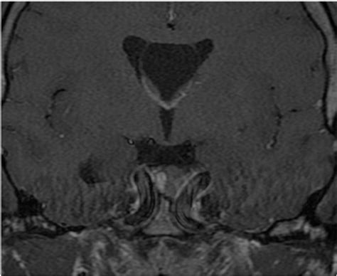 Carotid Sulcus Semantic Scholar