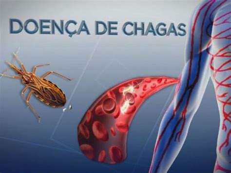 Doenças De Chagas Linny Bello Quizur