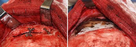 Plastic Surgery Case Study The One Piece Bone Flap Technique In Male
