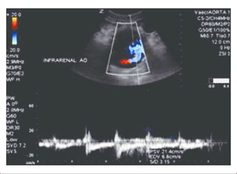 Duplex Sonography With Spectral Doppler Demonstrating Flow Outside The