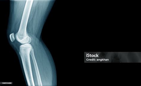 블루 톤의 X 선 이미지 Og 무릎 관절 Stenosis에 대한 스톡 사진 및 기타 이미지 Stenosis 무릎뼈 이미지