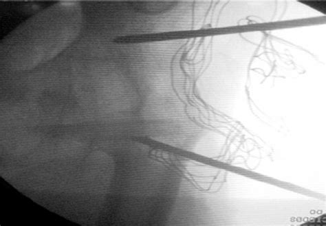 A This Preoperative Ap Pelvic X Ray Illustrates An Example Of