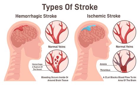 World Stroke Day Why Saving Precioustime Is Imperative