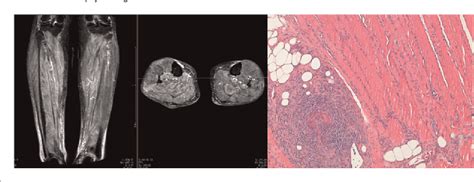 Figure 1 From Digital Ulcers As A Sentinel Sign For Early Internal