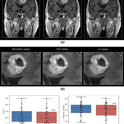 Denoising Dl Model Representative Mri Of Reference Images Fast