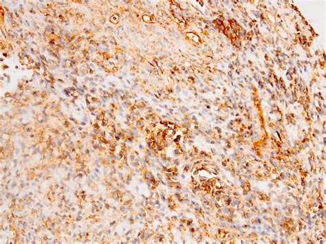 Pathology Outlines Sarcomas With Bcor Genetic Alterations