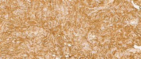 Follicular Dendritic Cell Sarcoma An Uncommon Lymphatic Neoplasm Eurorad