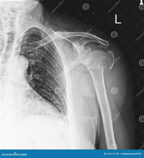 X Ray Shoulder A Male 71 Year Oldfracture Of Humerus Stock Image Image Of Fracture Humerus