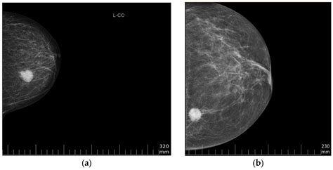 Cancers Free Full Text Attention Based Deep Learning System For Classification Of Breast