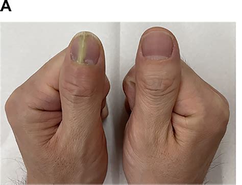 Ultrasound And Magnetic Resonance Image Findings In A Patient With A Subungual Abscess A Case