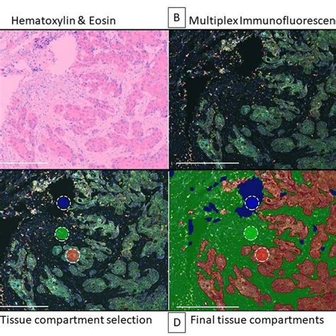 Tumor Microenvironment Tme Pd L1 Tumoral Cell Expression And Pd 1