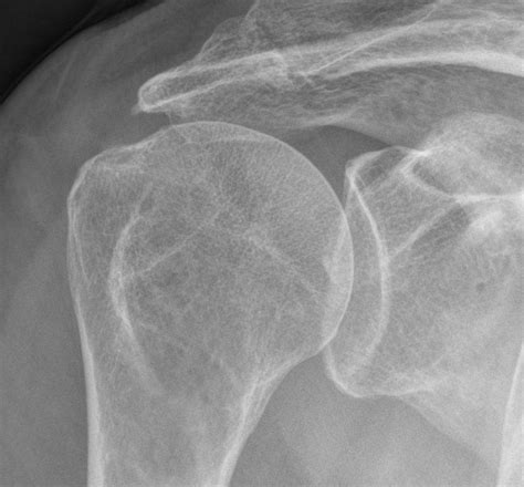 Cuff Tear Arthropathy The Bone School
