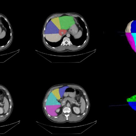 Medical Segmentation Decathlon Task 08 57 With Annotations From Tian