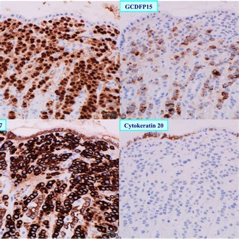 Pathologic Findings Of Invasive Lobular Carcinoma Metastasis Gata