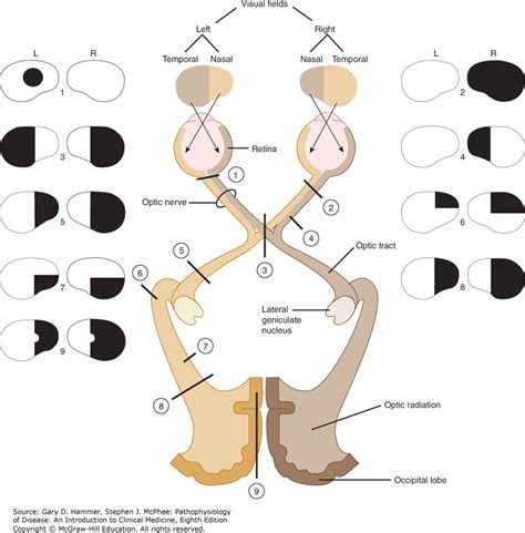 Quadrantanopia Wikipedia