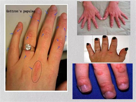 Para Neoplastic Malignant Syndromes Ppt Free Download